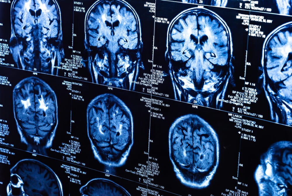 Promising Discovery for a Non-Invasive Early Detection of Alzheimer's ... Promising Discovery for a Non-Invasive Early Detection of Alzheimer's ...