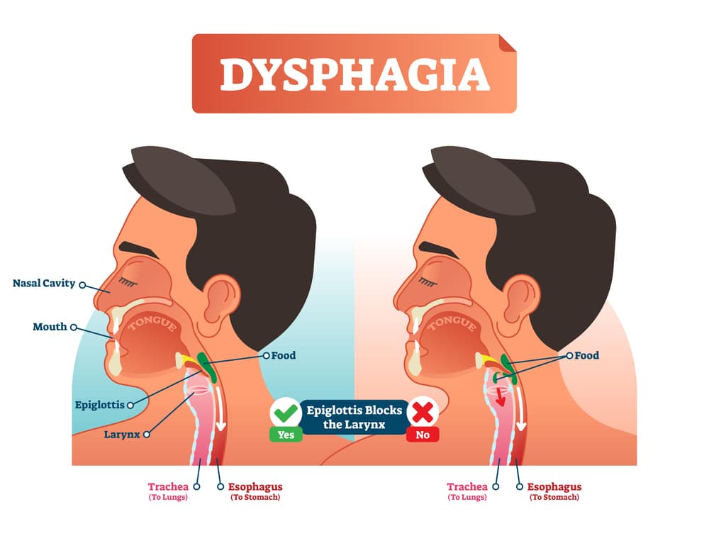 Dysphagia Difficulty Swallowing Treatment Options Available Regardless